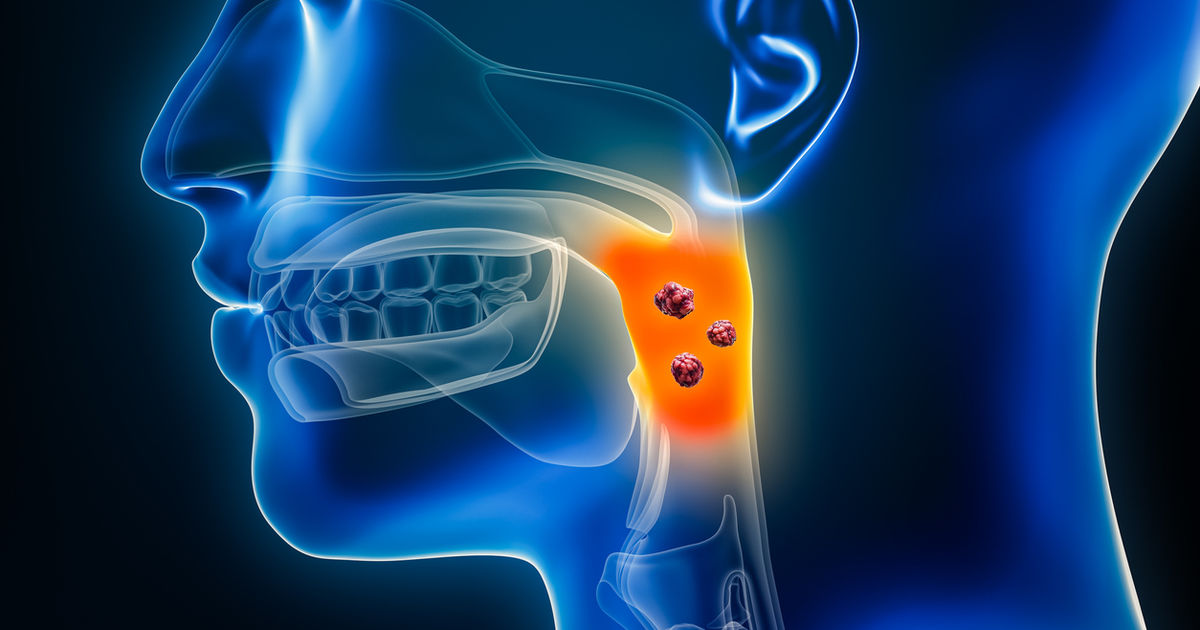 Epidemiology Of Hpv In Head And Neck Cancer Variant A Snapshot of Head ...